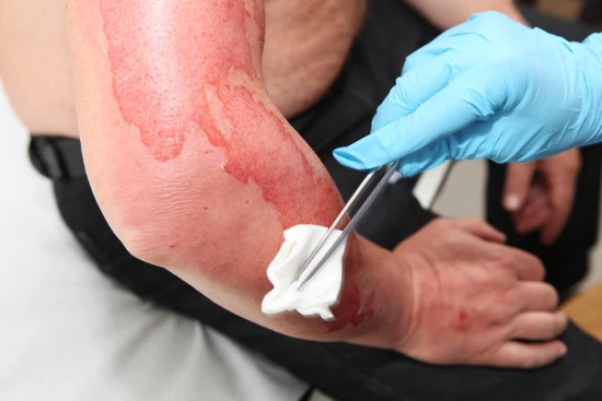 Auburn Personal Injury Lawyer | Injuries Caused by Negligence